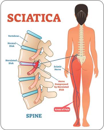 Sciatica Treatment, Symptoms & Causes | ANSSI