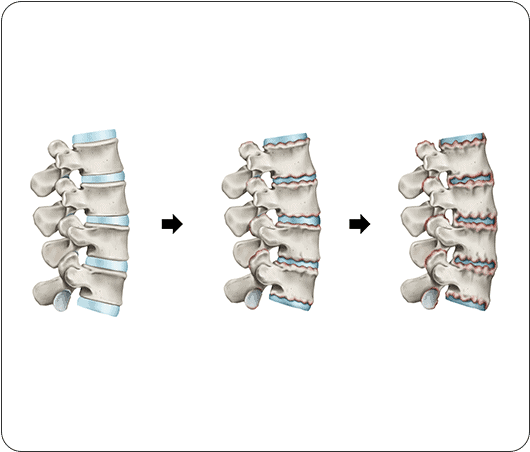 Spondylitis Treatment, Symptoms & Causes | ANSSI
