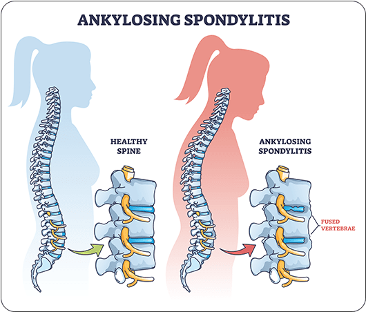 Ankylosing Spondylitis Treatment, Symptoms & Causes Ankylosing Spondylitis Treatment, Symptoms & Causes