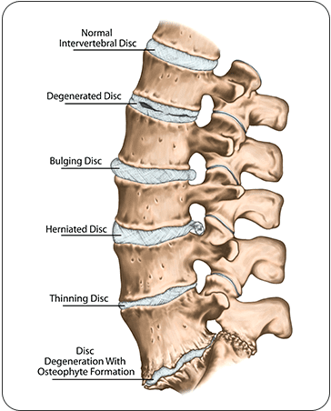 Degenerative Disc Disease Treatment, Symptoms & Causes