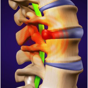 Spinal Stenosis vs. Herniated Disc: Understanding the Differences ...