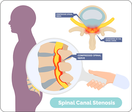 Spinal Canal Stenosis Treatment, Symptoms & Causes | ANSSI