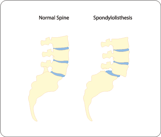 Spondylolisthesis Treatment, Symptoms & Causes | ANSSI