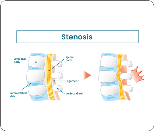 Stenosis Treatment, Symptoms & Causes | ANSSI