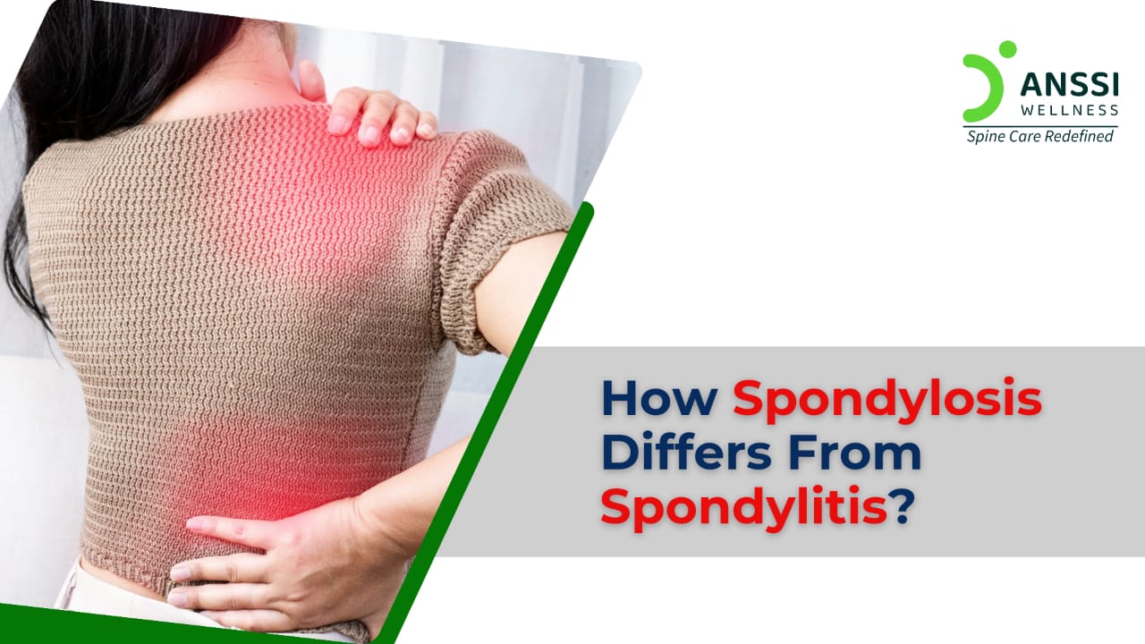 How Spondylosis Differs from Spondylitis