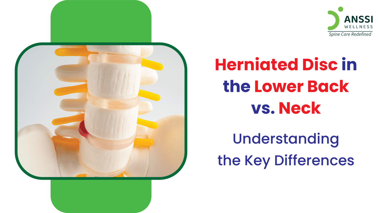 Herniated Disc Treatment: Causes, Symptoms & Non-Surgical Relief