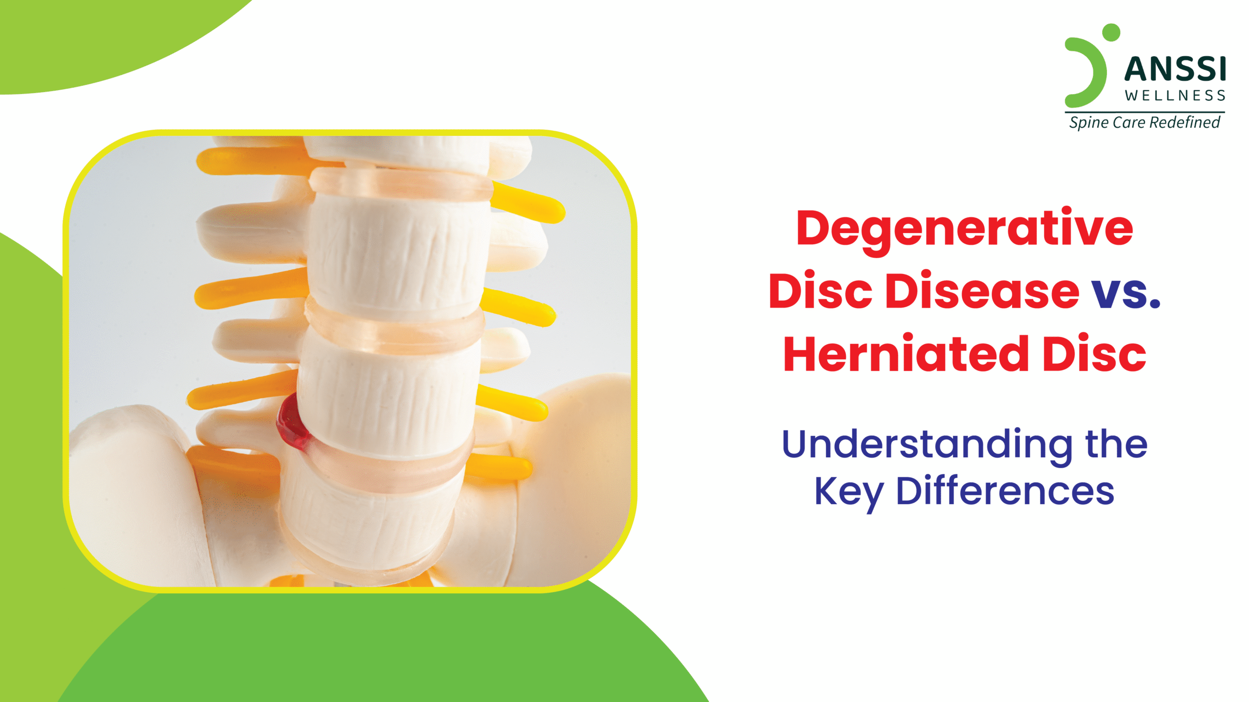 Degenerative Disc vs Herniated Disc – Know the Difference