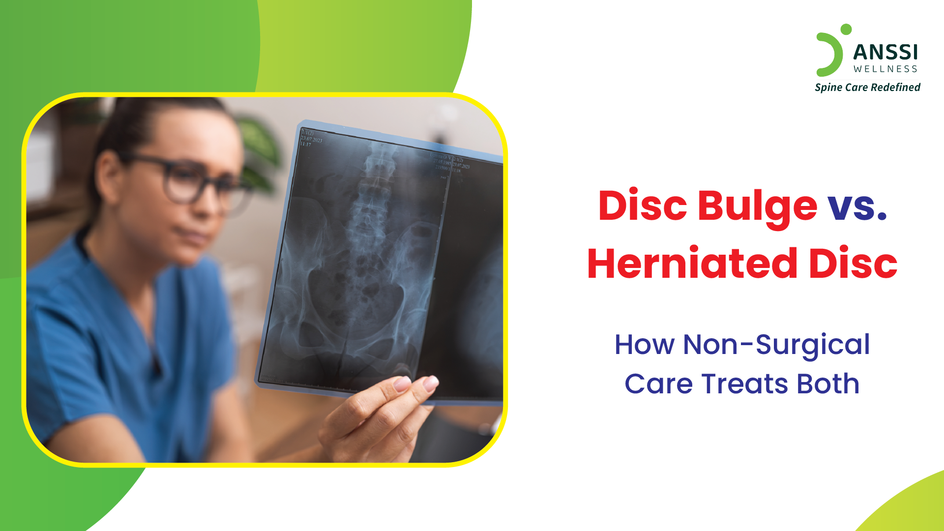 Disc Bulge vs Herniated Disc Treatment